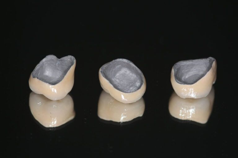 PFM Restorations | Georgetown, ON | Diana Dental