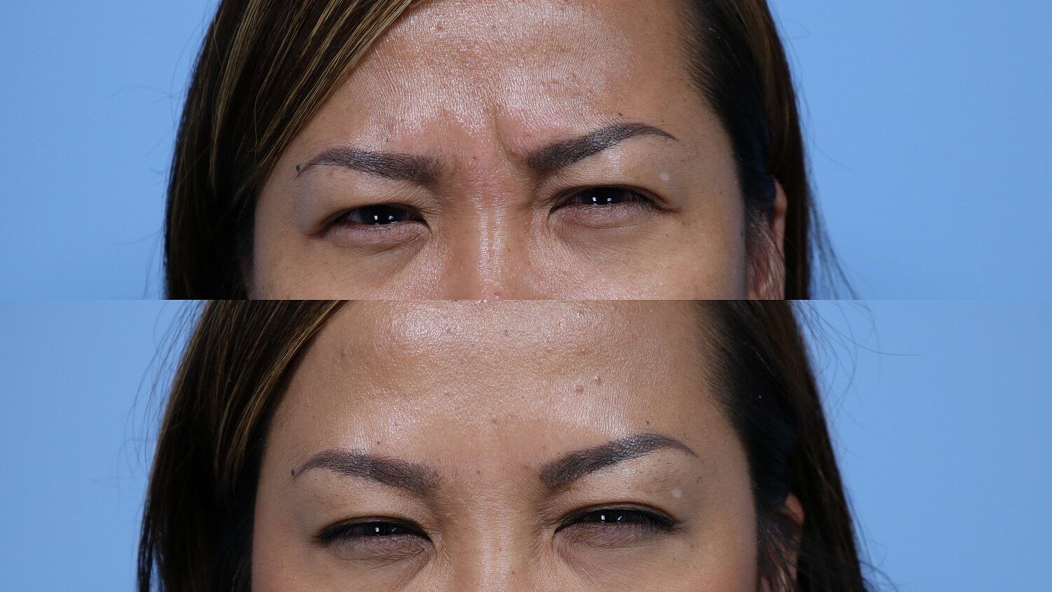 How Much BOTOX® Cosmetic Will I Need? | L&P Aesthetics