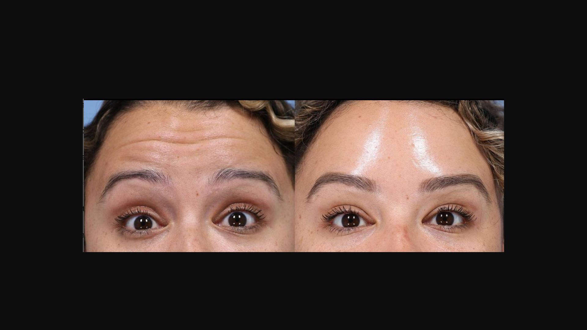 Baby BOTOX: What To Know Before Starting Botox | L&P Aesthetics