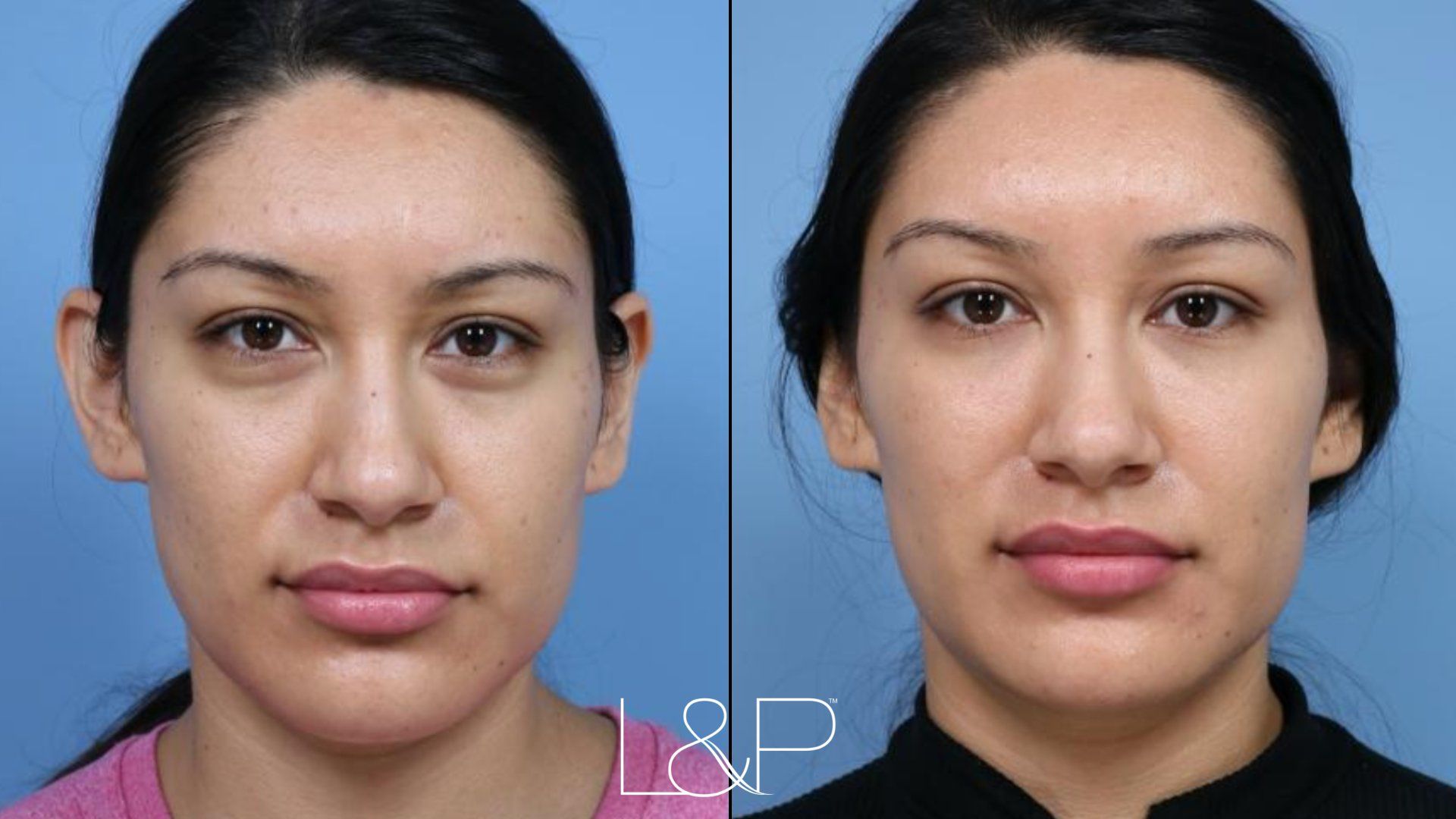 Facial Fillers: 10 Reasons You May Love Them! | L&P Aesthetics
