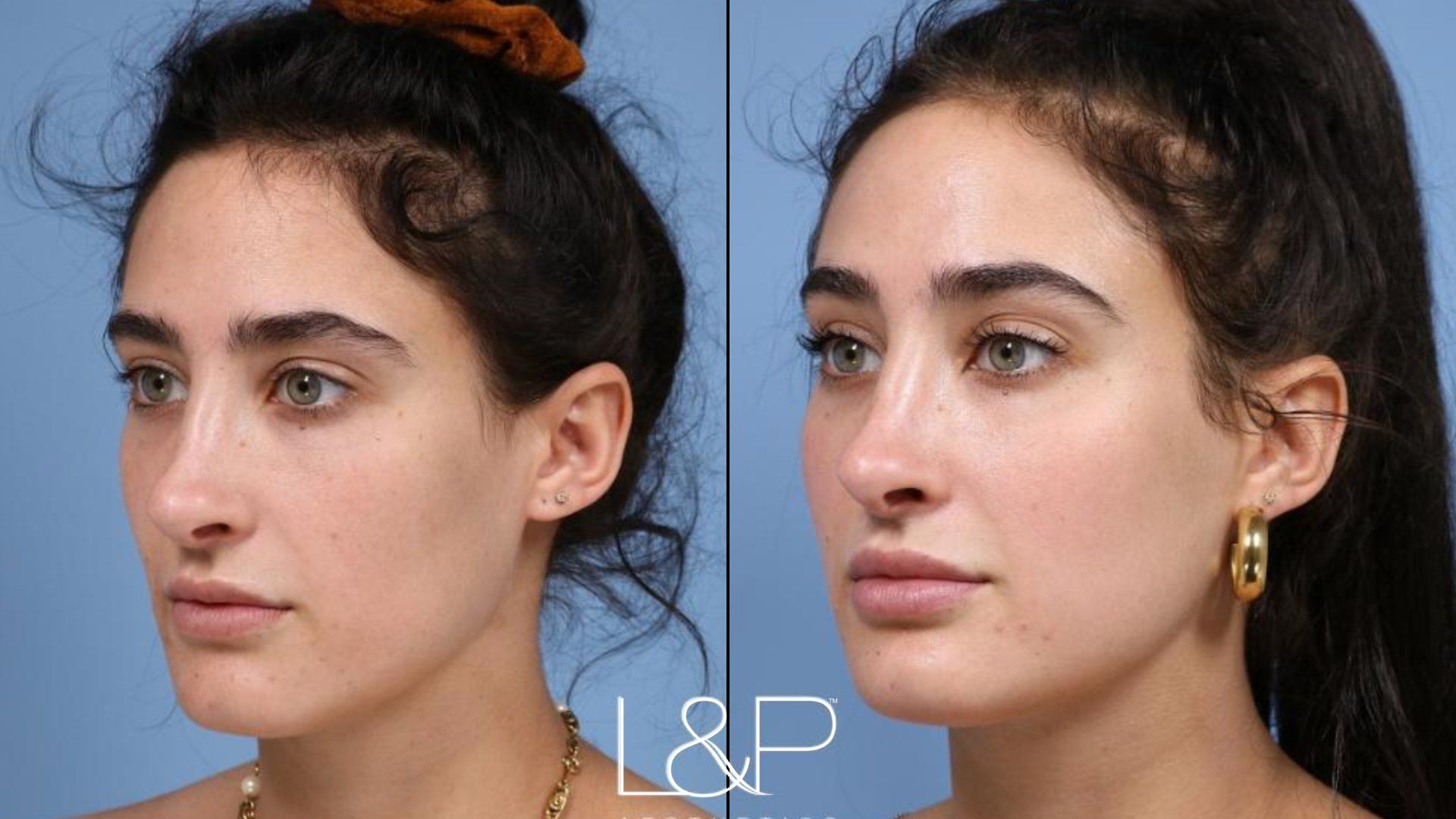 Facial Fillers: 10 Reasons You May Love Them! | L&P Aesthetics