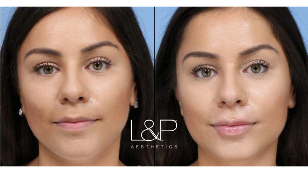 Facial Fillers: 10 Reasons You May Love Them! | L&P Aesthetics