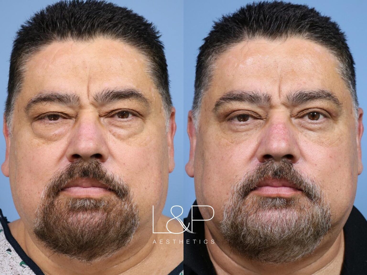Blepharoplasty Before And After | L&P Aesthetics