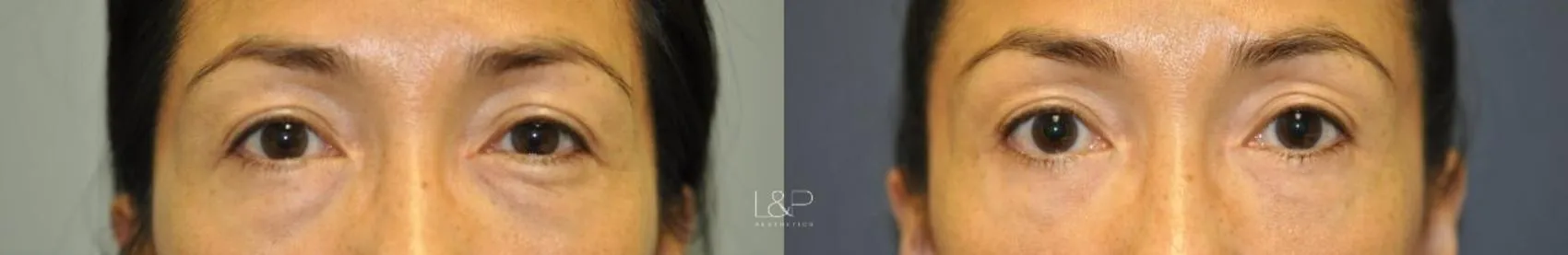 Lower Eyelid Blepharoplasty With Fat Transposition, Case 3 | L&P Aesthetics