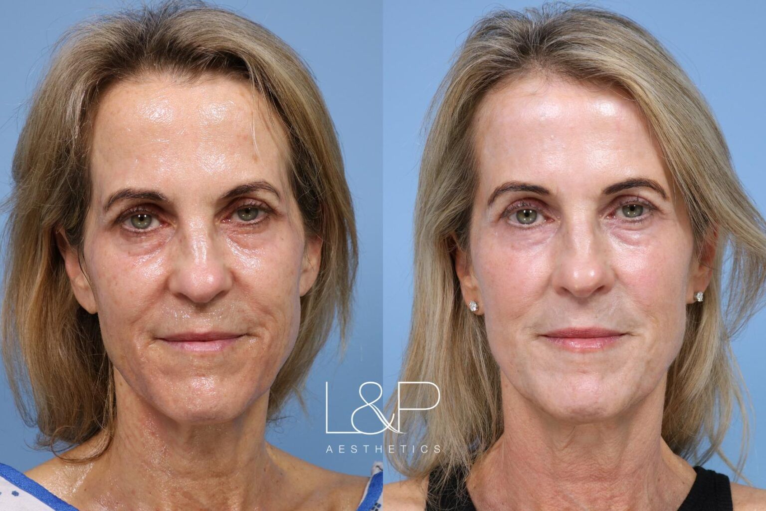 Laser Resurfacing (TRL) Before And After | L&P Aesthetics