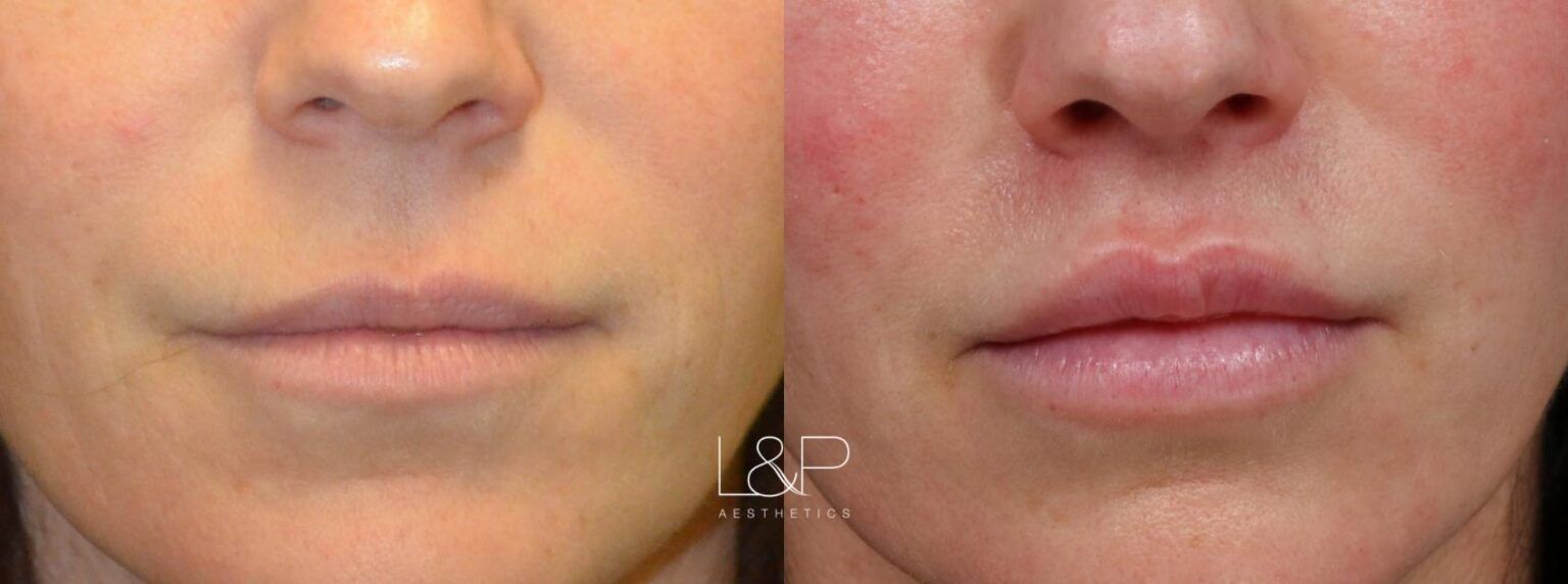 Lip Lift Before And After | L&P Aesthetics