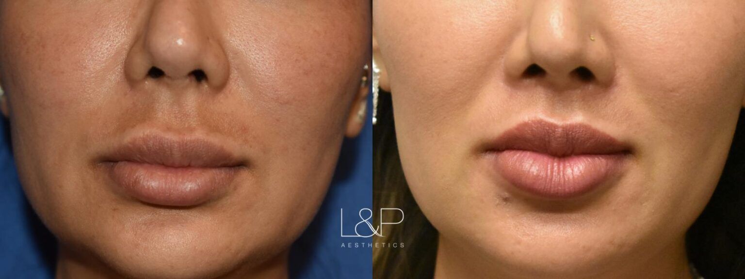 Lip Lift Before And After | L&P Aesthetics