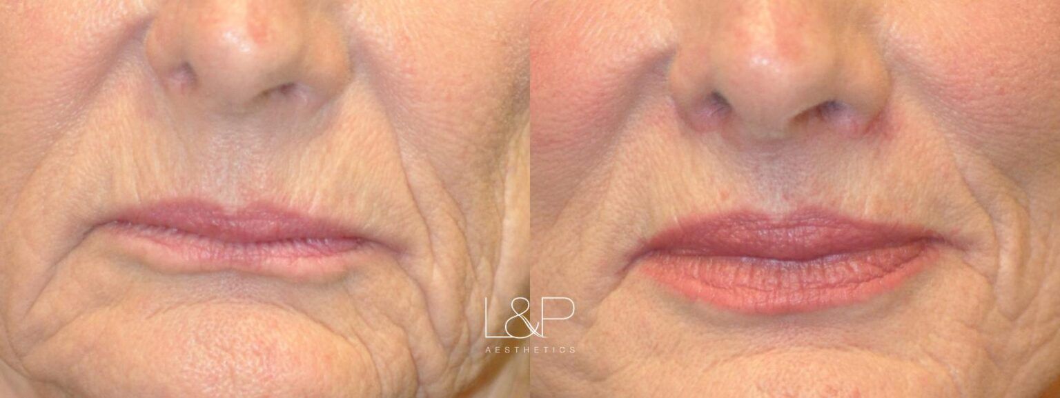 Lip Lift Before And After | L&P Aesthetics