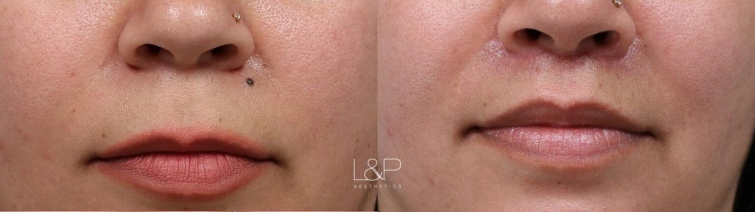 Lip Lift Before And After | L&P Aesthetics
