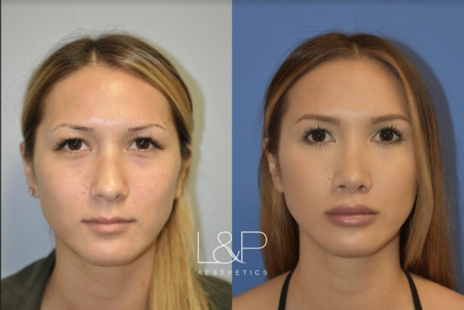 Lip Lift Before And After | L&P Aesthetics