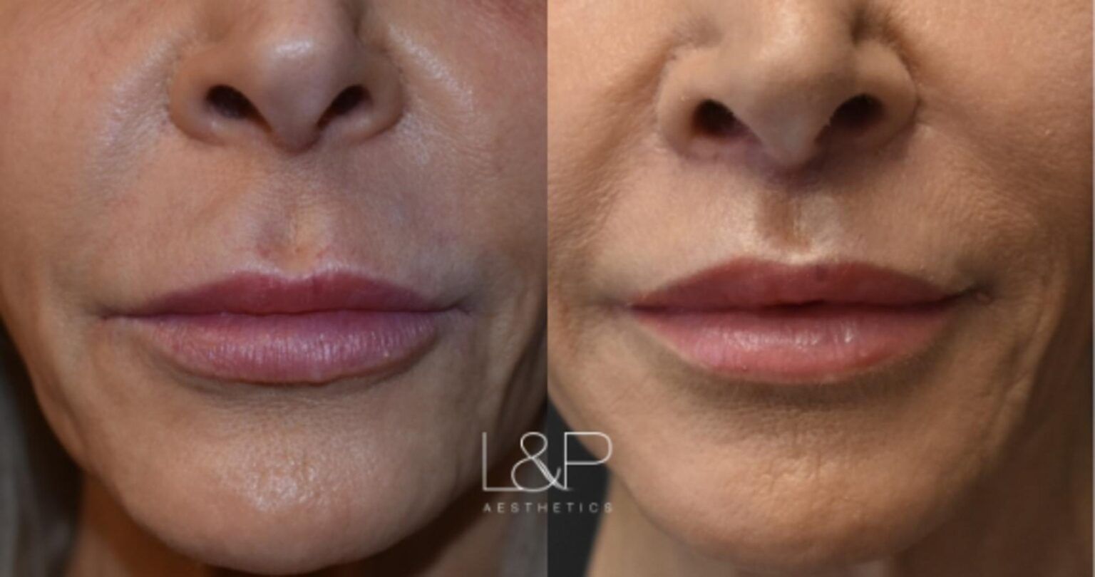 Lip Lift Before And After | L&P Aesthetics
