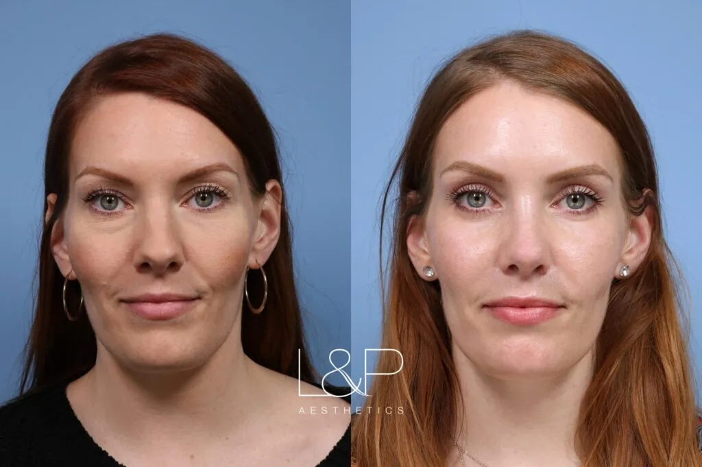 Laser Resurfacing (TRL) Before And After | L&P Aesthetics