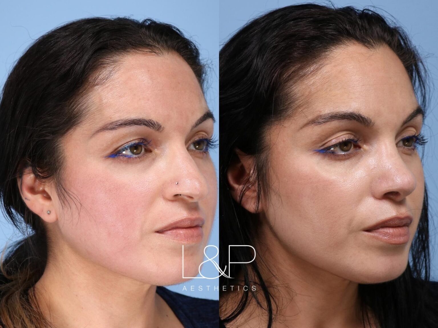 Rhinoplasty Before And After | L&P Aesthetics
