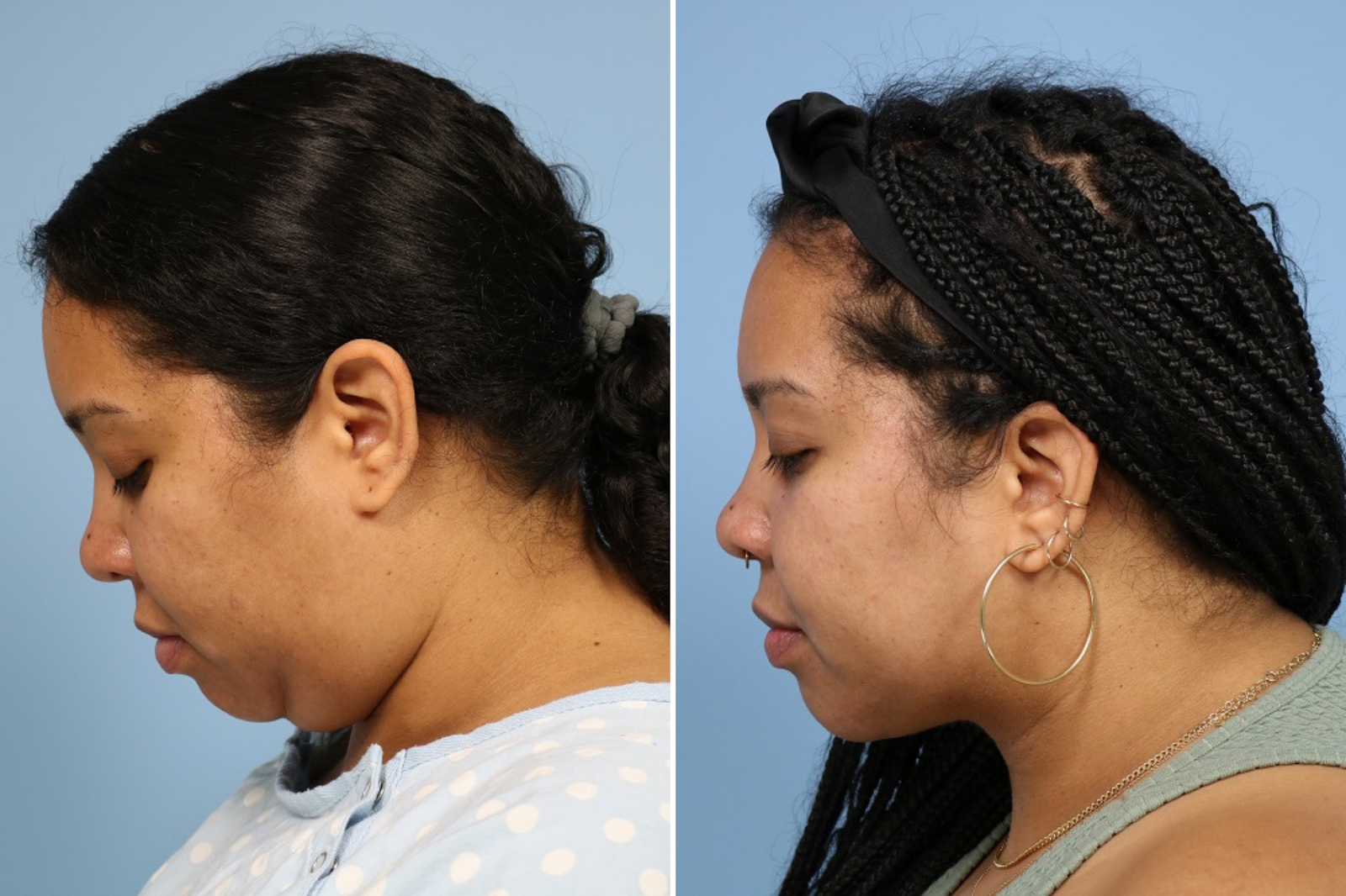 What Is Deep Neck Contouring?