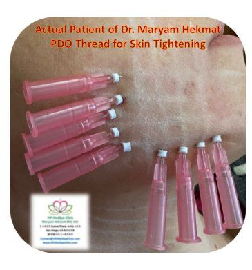 PDO Thread for Non-Surgical Facelift and Skin Tightening | VIP MedSpa ...