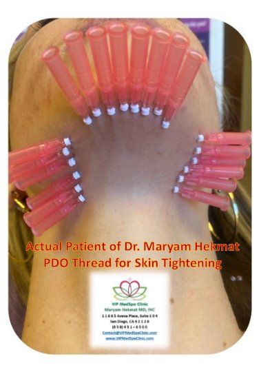 PDO Thread for Non-Surgical Facelift and Skin Tightening | VIP MedSpa ...