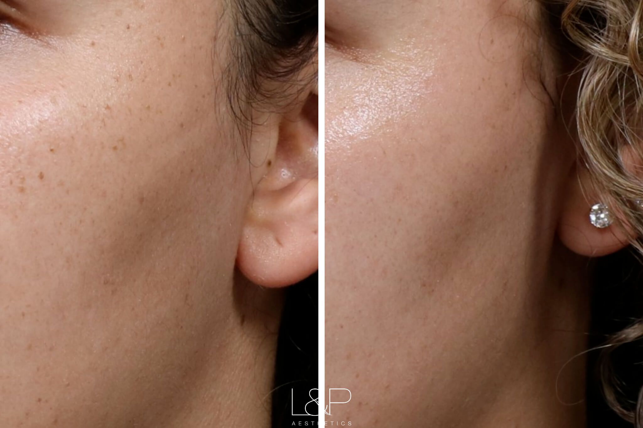 Chemical Peels in Palo Alto | Deep Chemical Peel Specialists