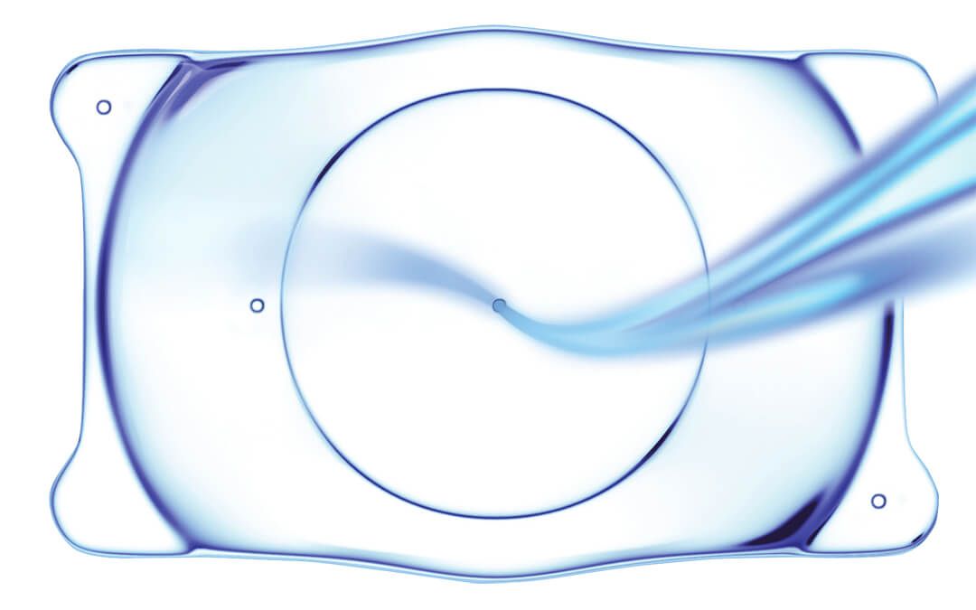 Implantable Lens (EVO ICL™) Treatment in San Diego, CA