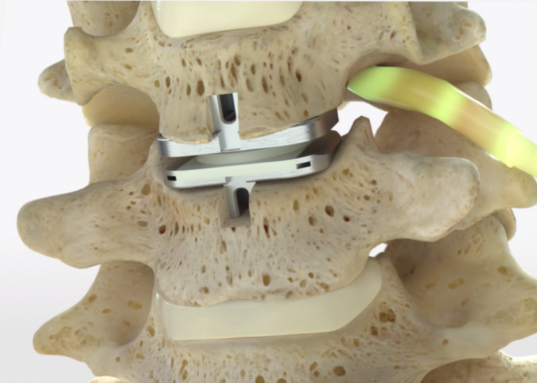 Cervical Disc Replacement - SWAN Brain Spine and Wellness