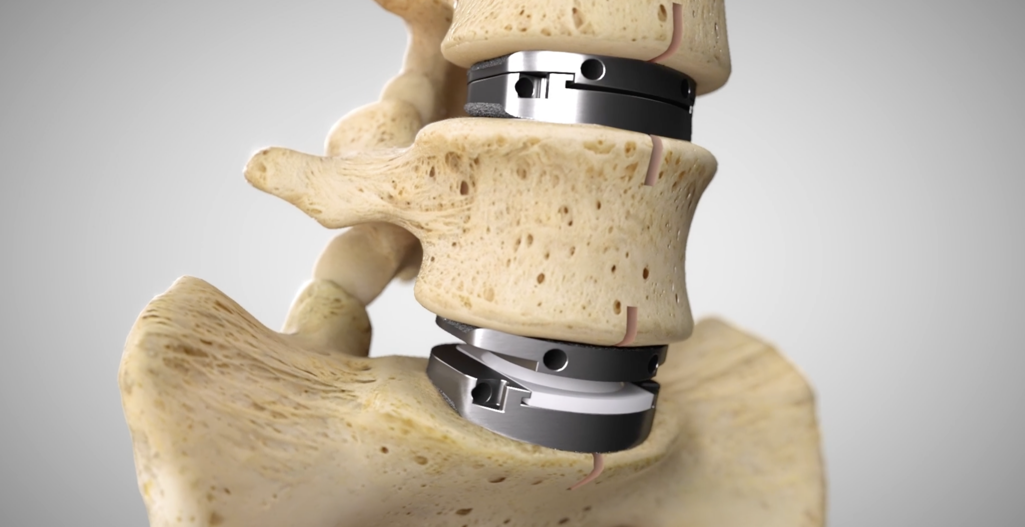 Lumbar Disc Replacement - SWAN Brain Spine and Wellness