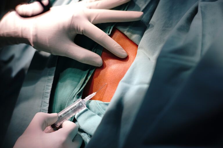 Sebaceous Cysts - Virginia Surgery Group - Reston, VA
