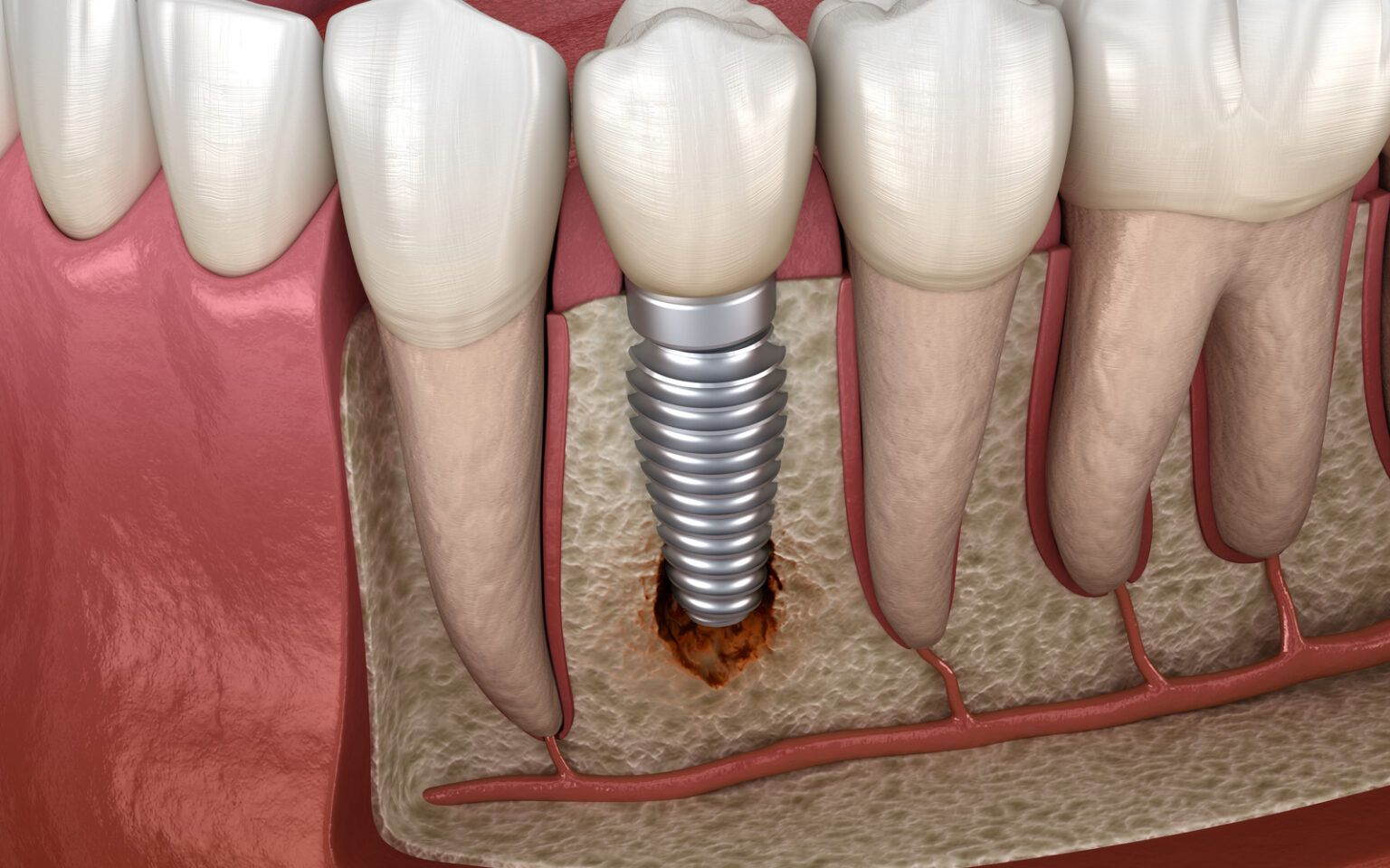 Fiber Post Techniques For Anatomical Root Variations - Raleigh Endodontics