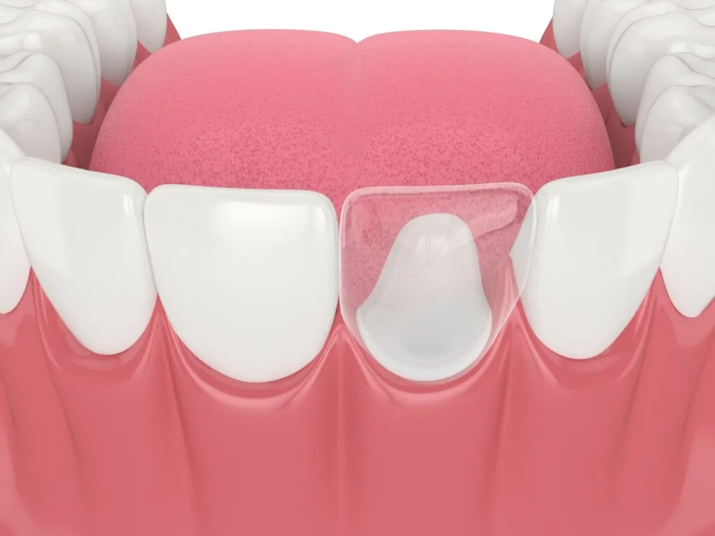 Procedures - Philp Family Dentistry
