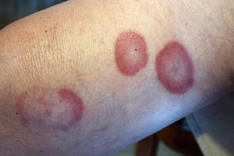Granuloma Annulare | Warren, OH | Warren Dermatology and Mohs Surgery