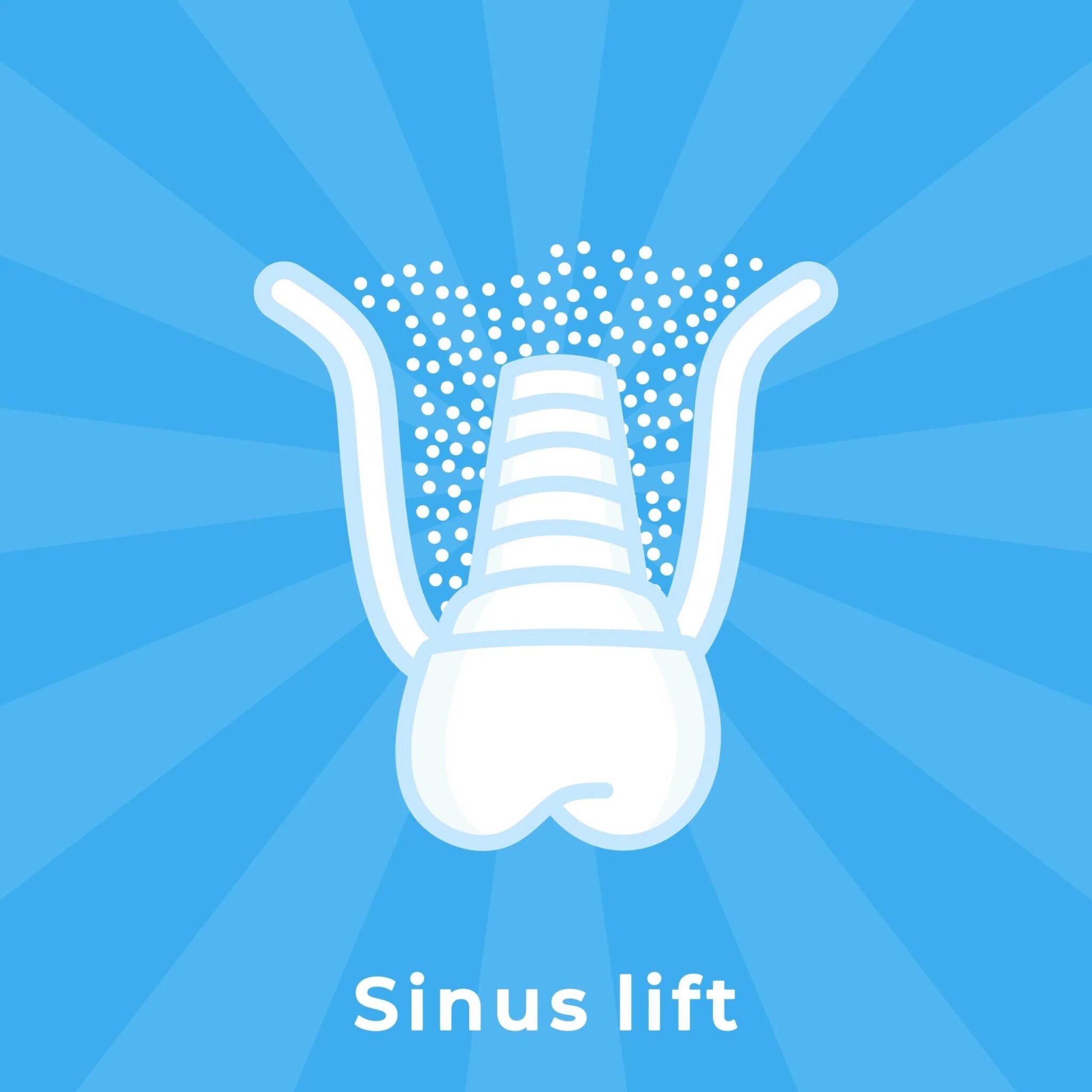 Exploring Sinus Lift Surgery: A Crucial Step Towards Successful Dental ...